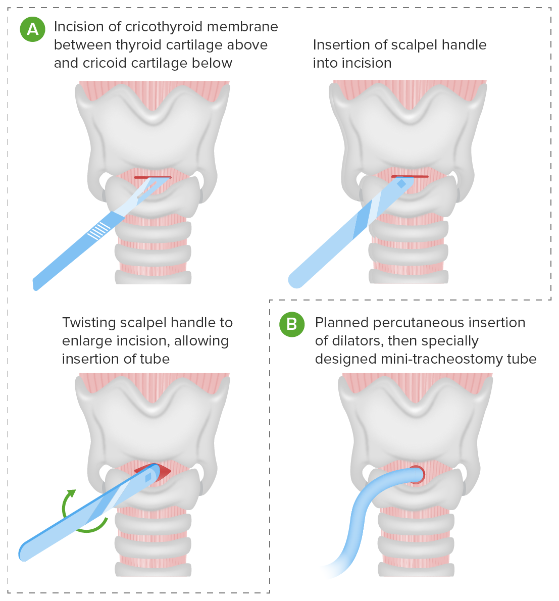 Cricothyroid Membrane Incision Cricothyroid Membrane Incision