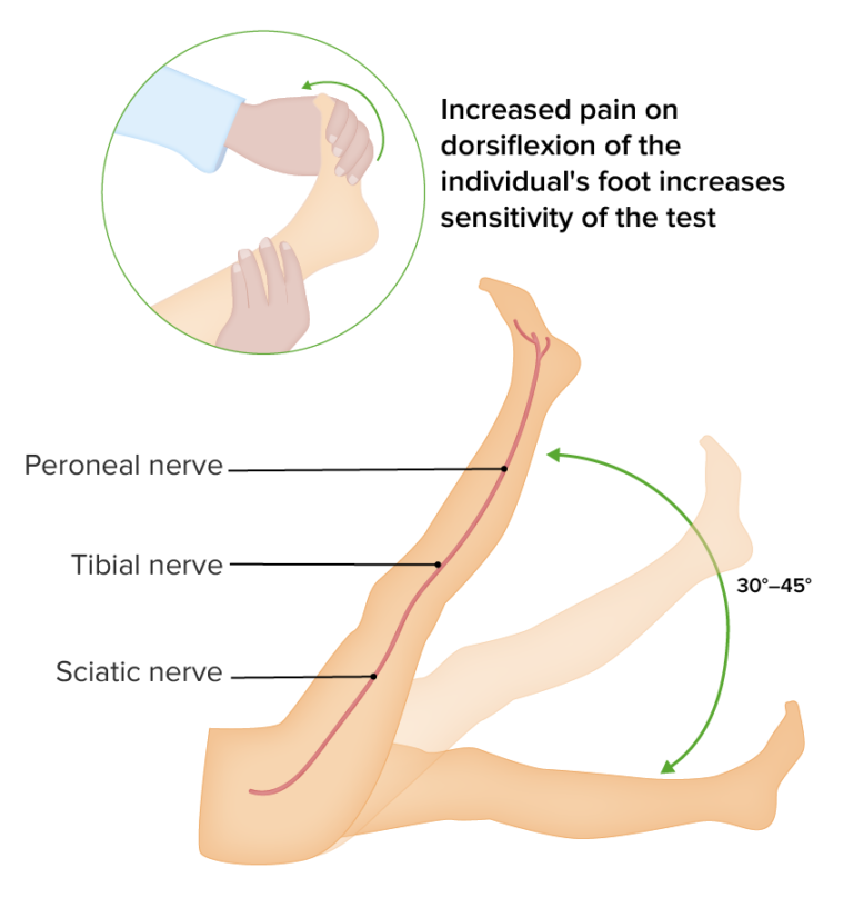 Spinal Disk Herniation | Concise Medical Knowledge