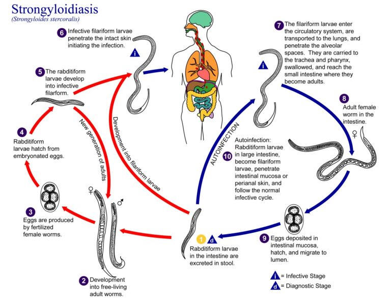 Strongyloidiasis | Concise Medical Knowledge