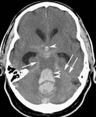 Hemorragia Subaracnoide (HSA) | Concise Medical Knowledge