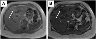 Imaging of the Liver and Biliary Tract | Concise Medical Knowledge