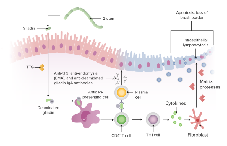 Celiac Disease | Concise Medical Knowledge