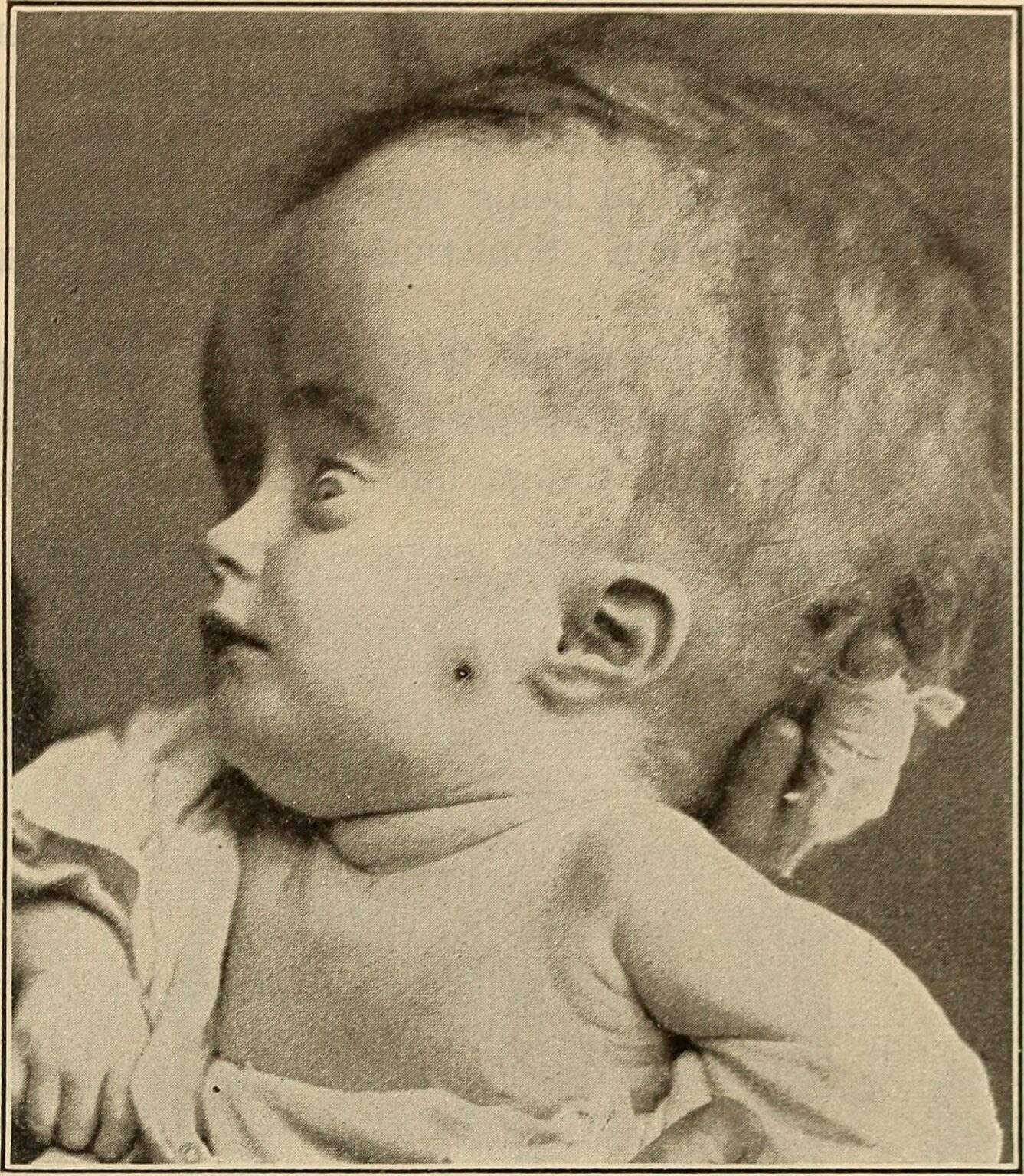 Hydrocephalus in Children | Concise Medical Knowledge