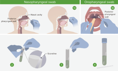 COVID-19 | Concise Medical Knowledge