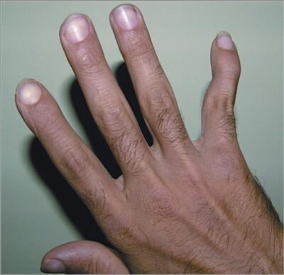 Rheumatoid Arthritis | Concise Medical Knowledge