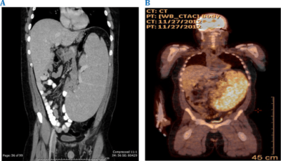 Splenomegaly | Concise Medical Knowledge