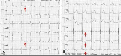 Aortic Regurgitation | Concise Medical Knowledge