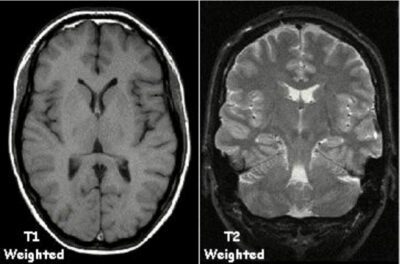 Magnetic Resonance Imaging (MRI) | Concise Medical Knowledge