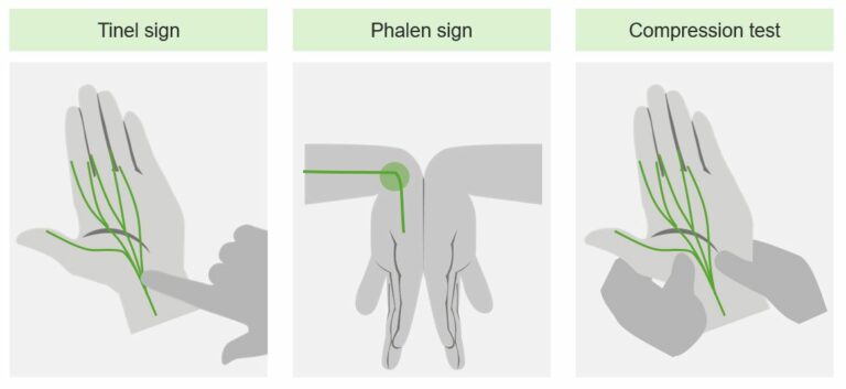 Peripheral Nerve Injuries in the Upper Extremity | Concise Medical ...