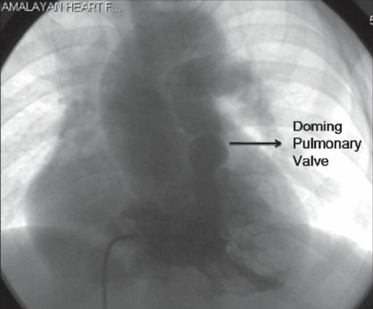 Pulmonary Stenosis | Concise Medical Knowledge