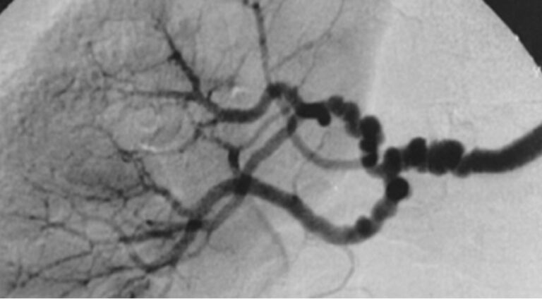 Estenose da Artéria Renal | Concise Medical Knowledge
