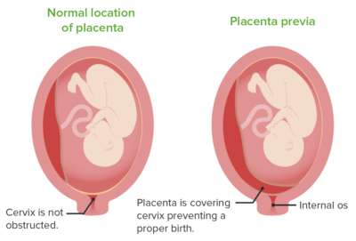Placental Abnormalities | Concise Medical Knowledge
