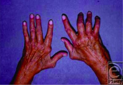Rheumatoid Arthritis | Concise Medical Knowledge