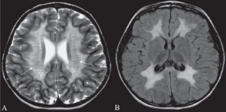 Metachromatic Leukodystrophy | Concise Medical Knowledge