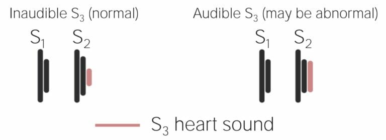 Heart Sounds | Concise Medical Knowledge