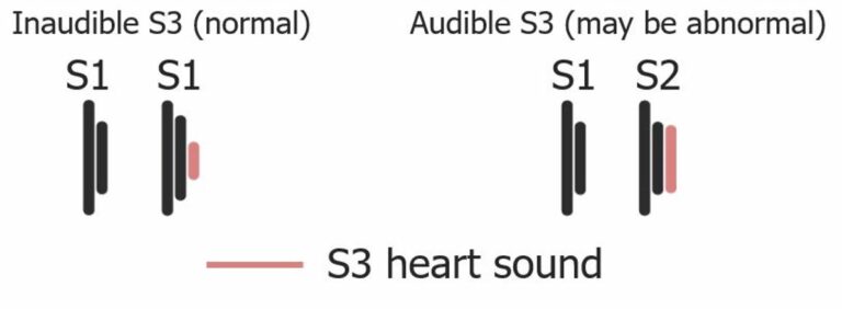 Heart Sounds | Concise Medical Knowledge