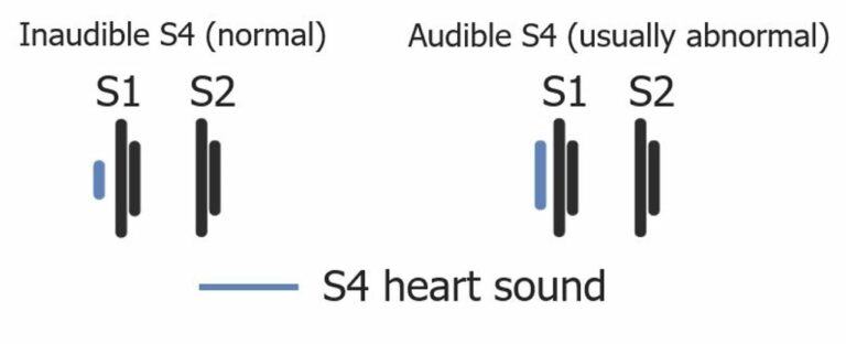 Heart Sounds | Concise Medical Knowledge