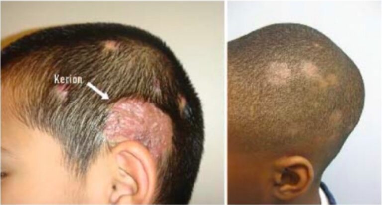 Alopecia | Concise Medical Knowledge
