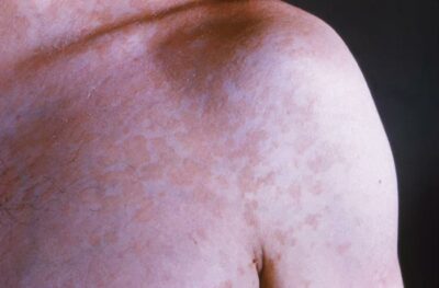 Malassezia Fungi | Concise Medical Knowledge