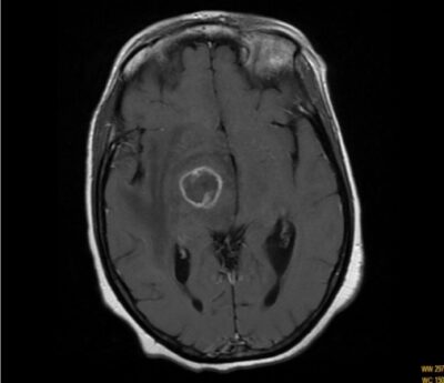 Toxoplasma/Toxoplasmosis | Concise Medical Knowledge