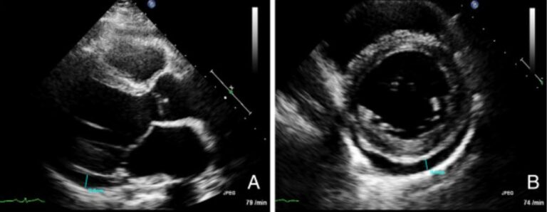 Myocarditis | Concise Medical Knowledge