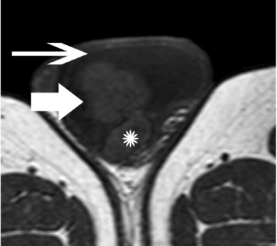 Imagenología Escrotal | Concise Medical Knowledge