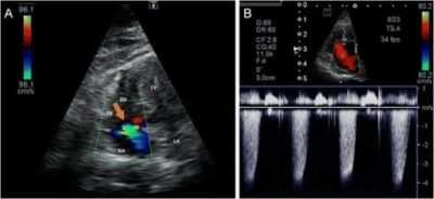 Tricuspid Regurgitation | Concise Medical Knowledge