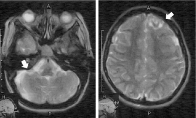 Tuberous Sclerosis | Concise Medical Knowledge
