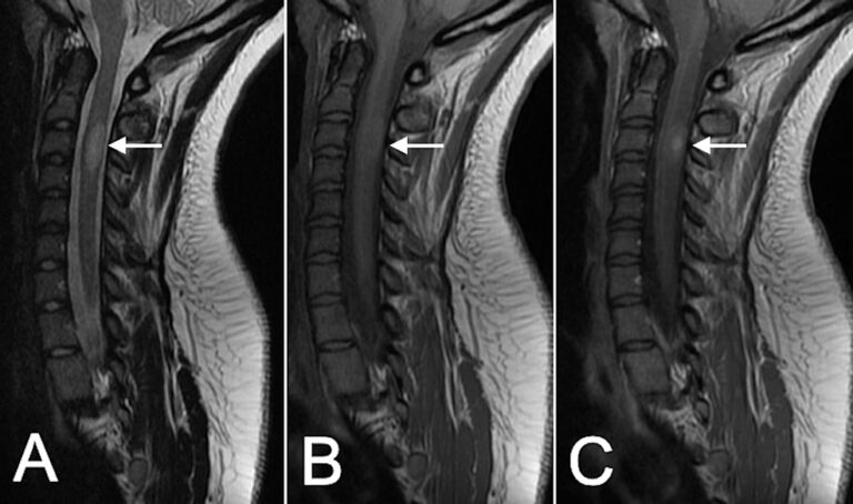 Imaging Of The Spine And Spinal Cord Concise Medical Knowledge