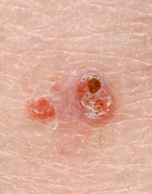 Primary Skin Lesions | Concise Medical Knowledge