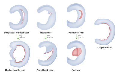 Meniscus Tear | Concise Medical Knowledge