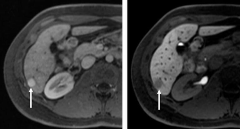Hepatocellular Carcinoma (HCC) and Liver Metastases | Concise Medical ...