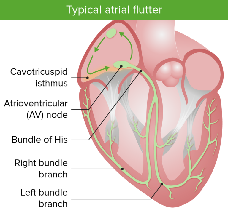 Atrial Flutter | Concise Medical Knowledge