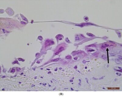 Varicella-Zoster Virus/Chickenpox | Concise Medical Knowledge
