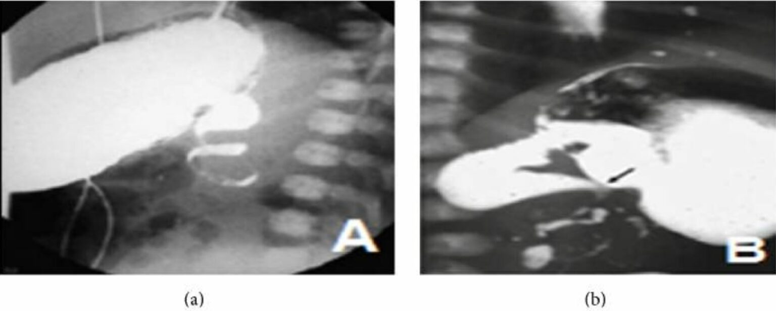 Intestinal Malrotation | Concise Medical Knowledge