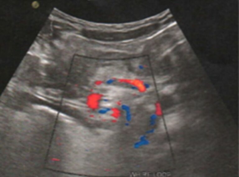 Intestinal Malrotation And Midgut Volvulus In A 1month