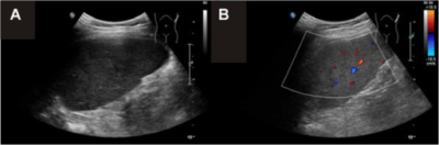 Imaging of the Spleen | Concise Medical Knowledge