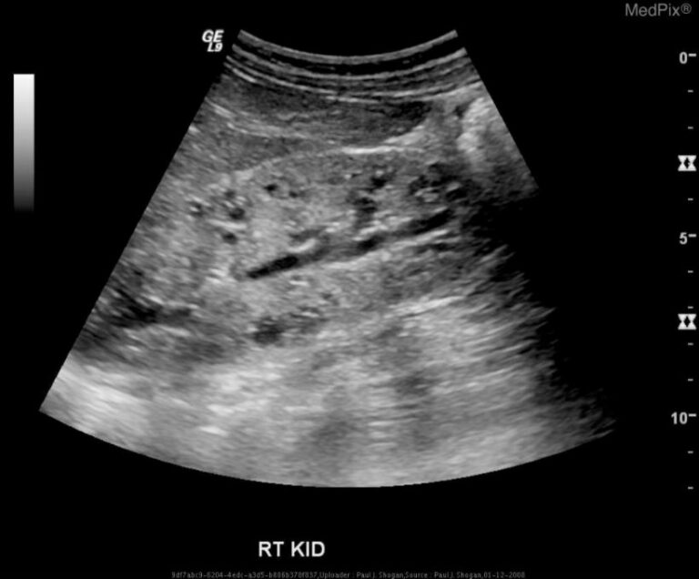 Ultrasound Diagnostic Criteria For Polycystic Kidney Disease at Loriann ...