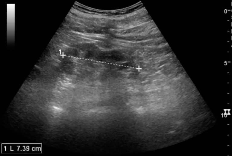 Pyelonephritis and Perinephric Abscess | Concise Medical Knowledge