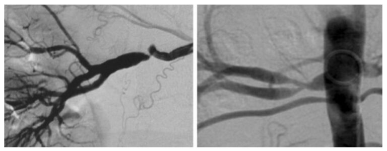 Fibromuscular Dysplasia | Concise Medical Knowledge