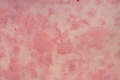 Urticaria (Habones) | Concise Medical Knowledge