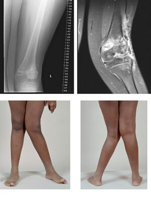 Dolor de Rodilla | Concise Medical Knowledge