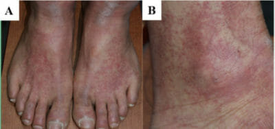 Acute Kidney Injury | Concise Medical Knowledge