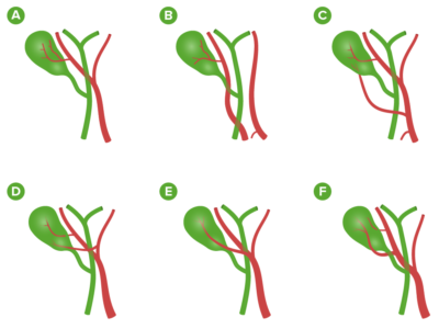Cholecystectomy | Concise Medical Knowledge