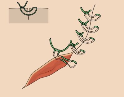 Surgical Instruments and Sutures | Concise Medical Knowledge