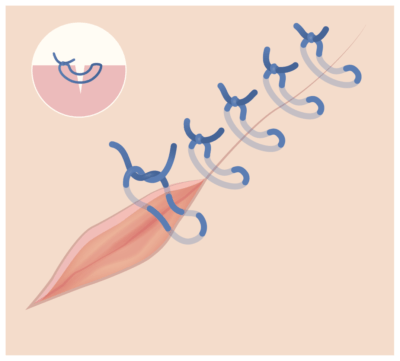 Surgical Instruments and Sutures | Concise Medical Knowledge