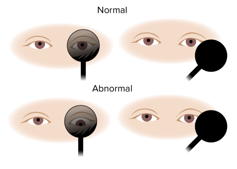 Vertigo | Concise Medical Knowledge