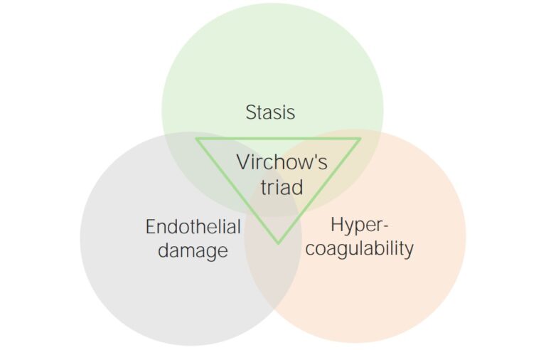 Hypercoagulable States | Concise Medical Knowledge
