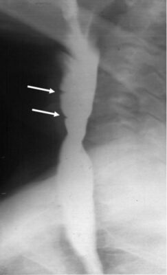 Disfagia | Concise Medical Knowledge