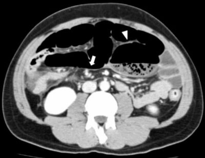 Volvulus | Concise Medical Knowledge